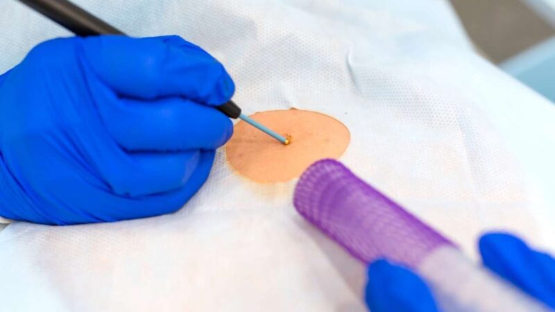 Biópsia: o que é, tipos de exame e como é feito - BoaConsulta